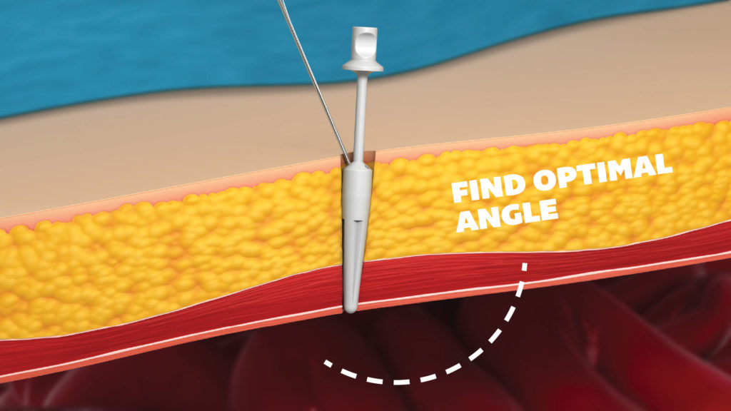 Joystick Laparoscopic & Robotic Port Closure System - Artisan Medical